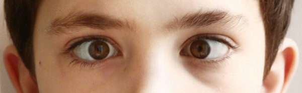 Strabismus Treatment Delhi, Squint, Misaligned Eyes Treatment East Delhi